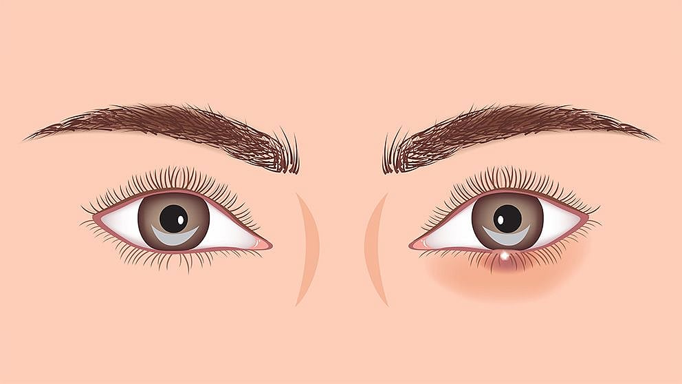 Gerstenkorn – Entstehung, Symptome & Behandlung | W